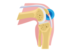 Knee apophysitis (Osgood Schlatter’s and Sinding-Larsen Johansson ...