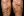Varicose veins | NHS inform
