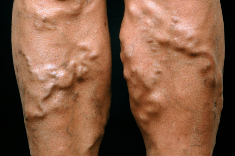 Varicose veins | NHS inform