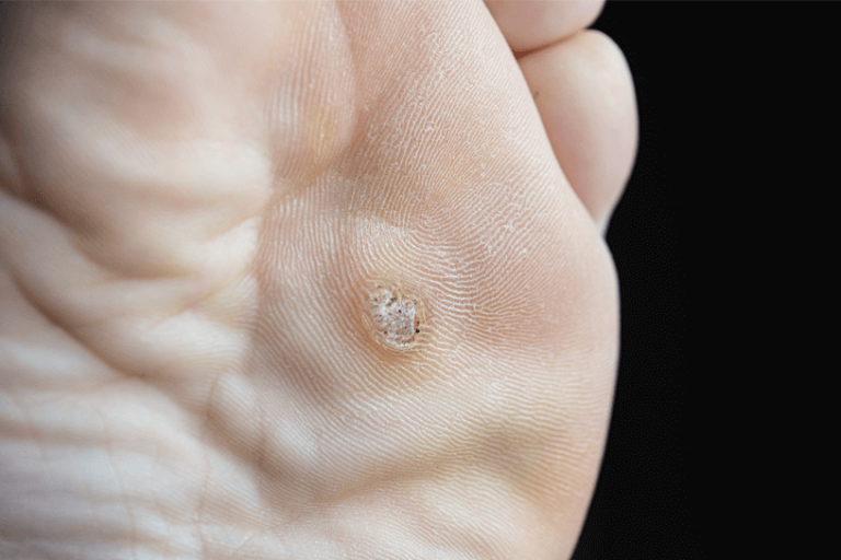Warts and verrucas | NHS inform